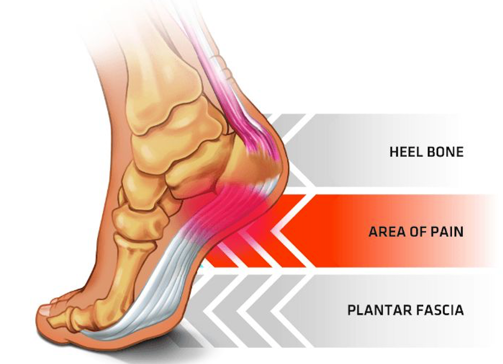 Foot Pain: Plantar Fasciitis – Fit Chiropractic